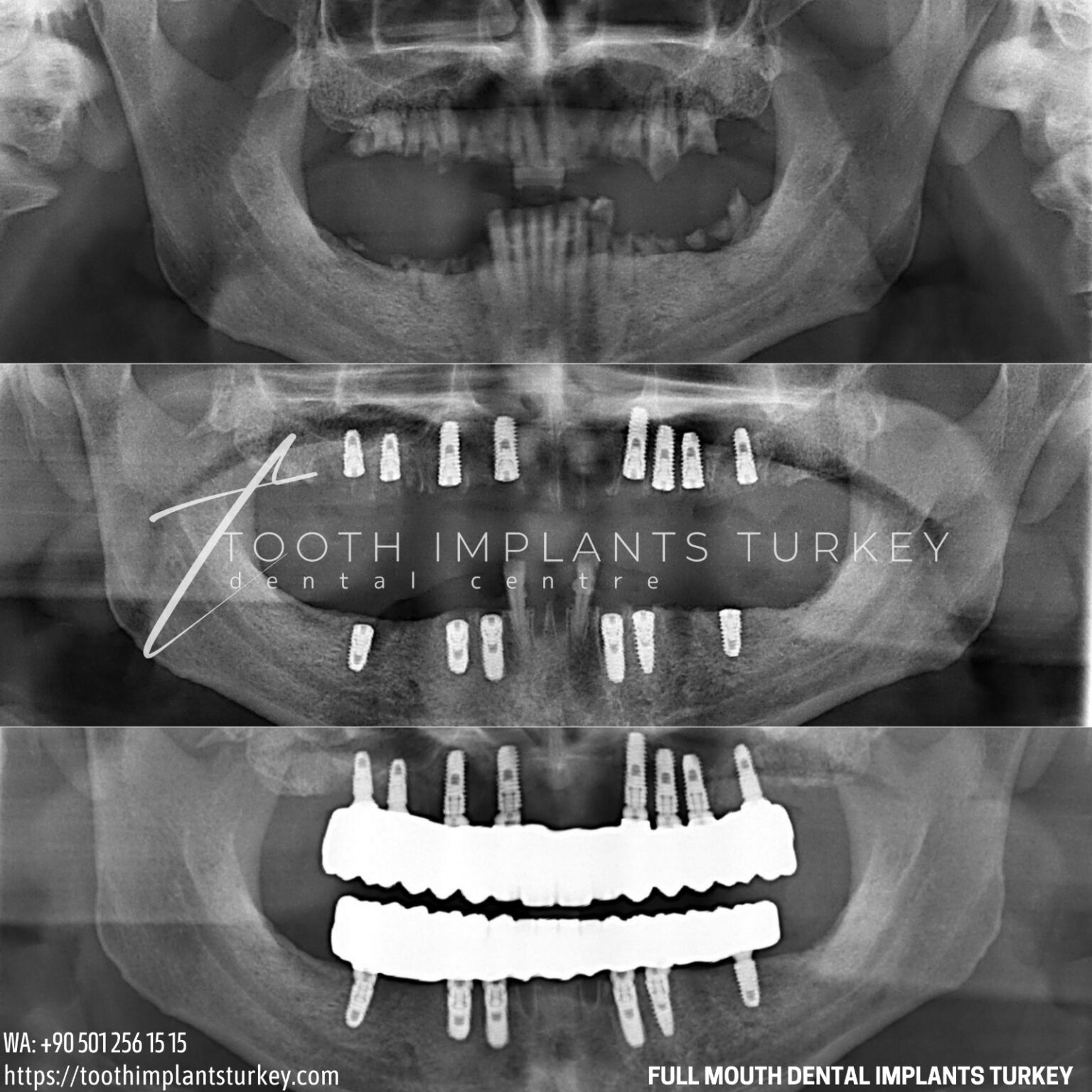 Full Mouth Dental Implants Turkey Price & Package Deals - Antalya