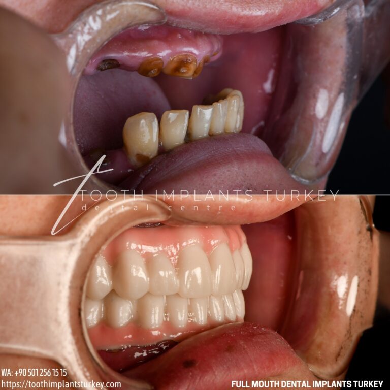Full Mouth Dental Implants Turkey Price & Package Deals - Antalya