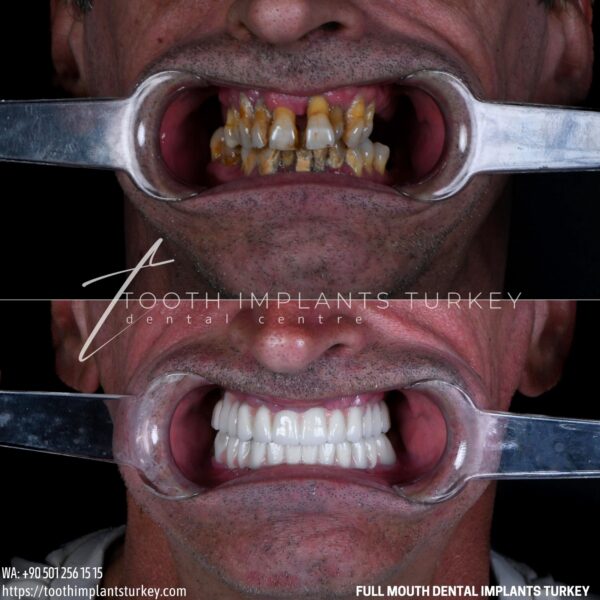 Full Mouth Dental Implants Turkey Price & Package Deals - Antalya