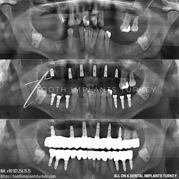 Turkey Teeth Before & After - Smile Gallery