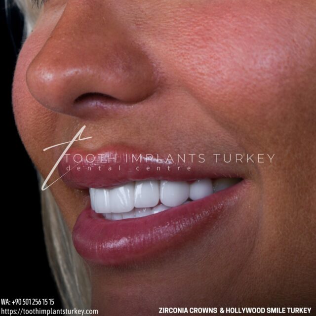 Turkey Teeth Before & After - Smile Gallery