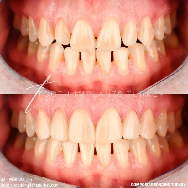 Composite Bonding Turkey: Cost, Veneers, Antalya, Price, Package