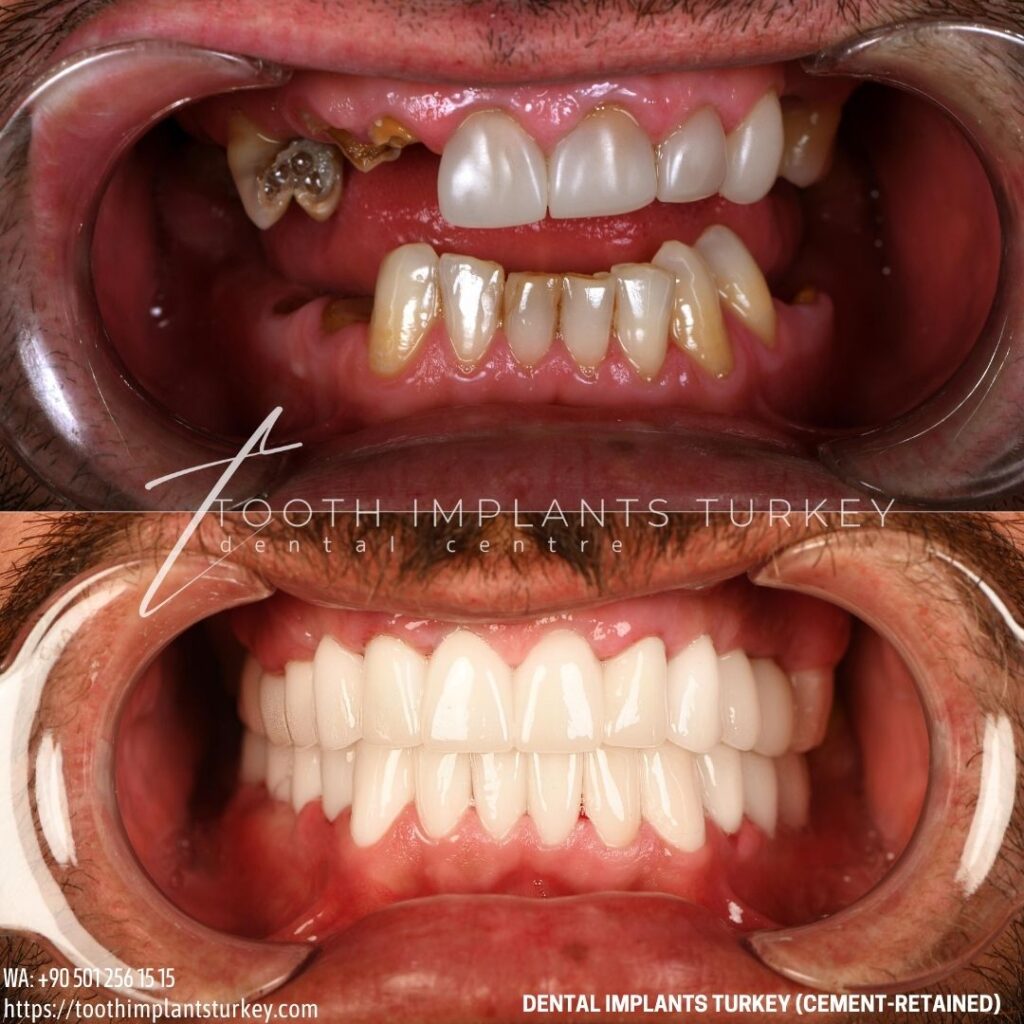 Tooth Implants Turkey Dental Centre: Cost, Packages, Antalya