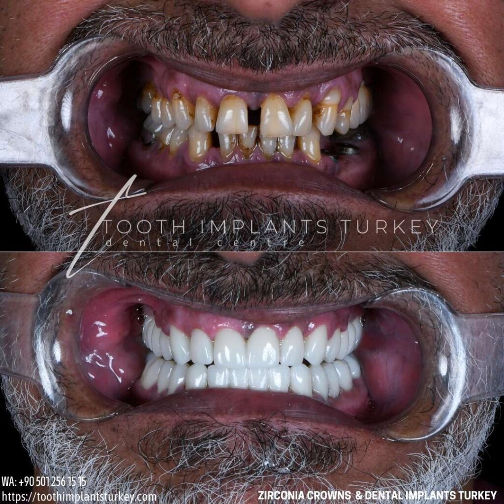 Tooth Implants Turkey Dental Centre: Cost, Packages, Antalya